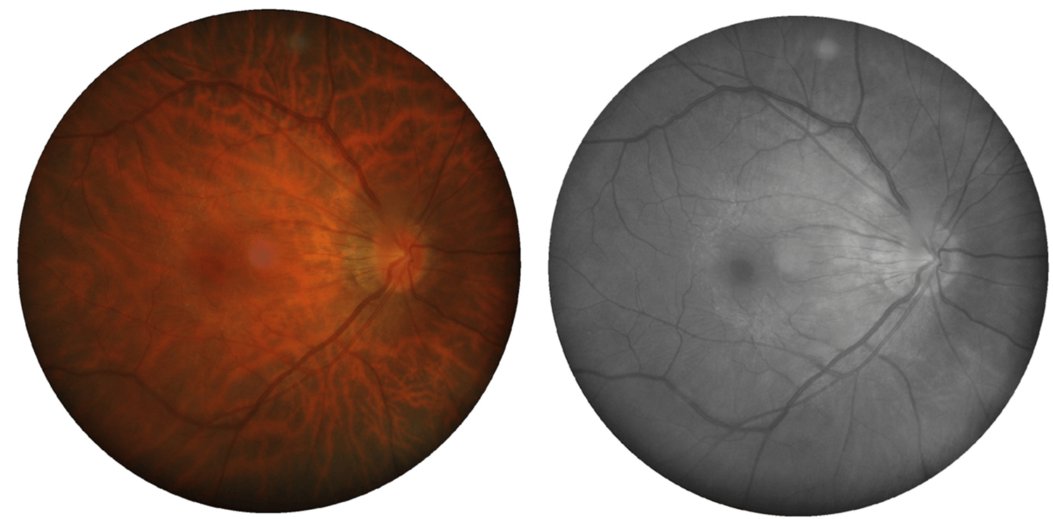 Epiretinal Membranes Looking Beyond the Macula - mivision