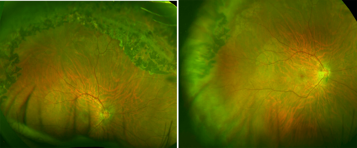 Epiretinal Membranes Looking Beyond the Macula - mivision