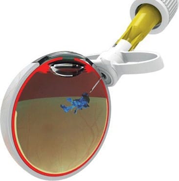 SP.Eye: Guiding the Future of Anti-VEGF Delivery - mivision