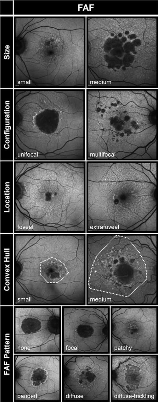 Management of Geographic Atrophy: Perspectives of Three Local Retina ...