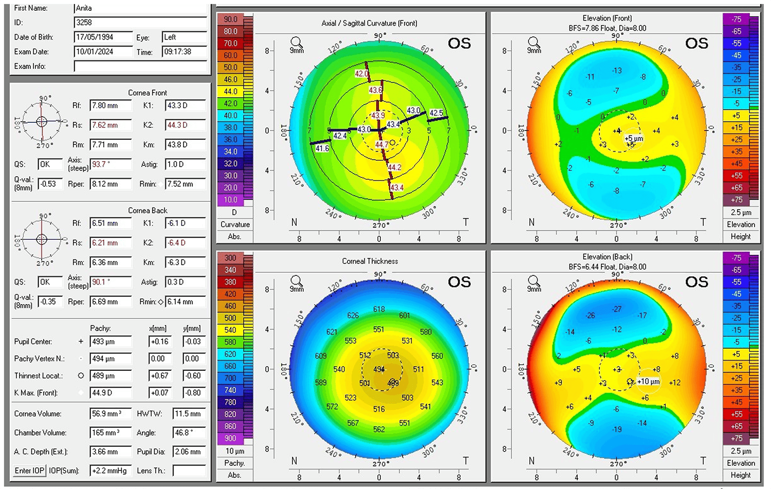 Advancements in Ectasia Screening for Refractive Surgery - mivision
