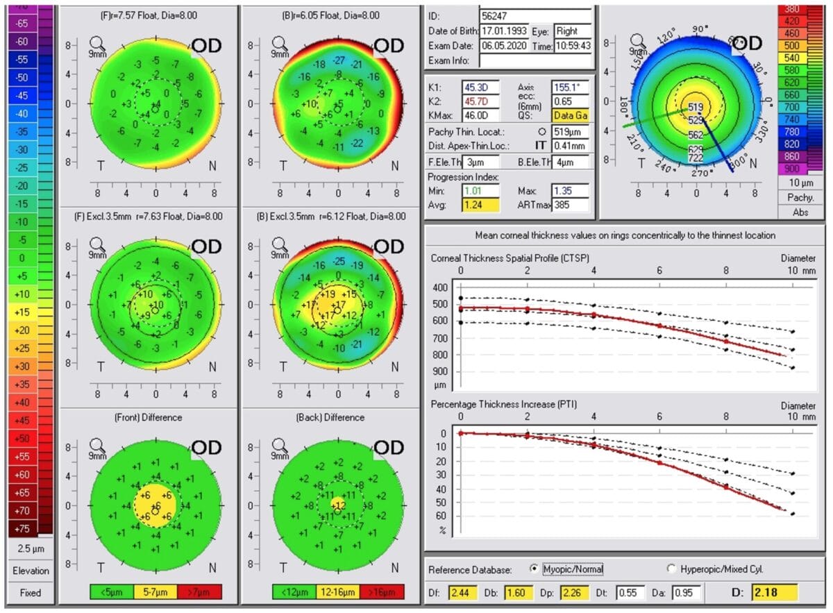 Advancements in Ectasia Screening for Refractive Surgery - mivision