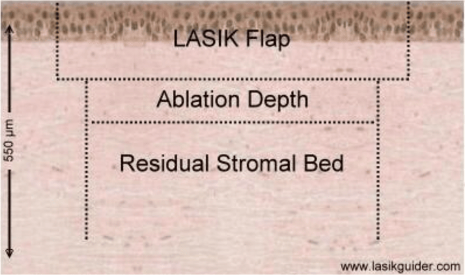 Advancements in Ectasia Screening for Refractive Surgery - mivision