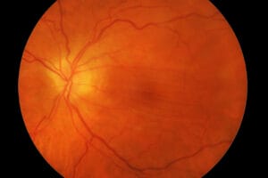 Choroidal Folds Benign Retinal Finding or Something More? - mivision