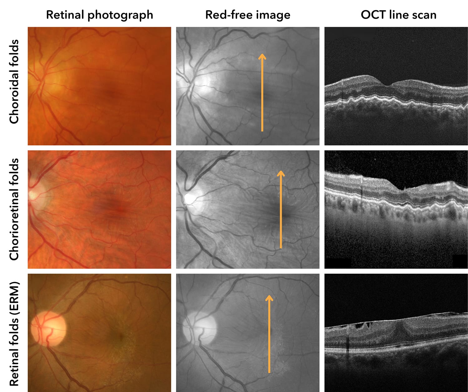 Choroidal Folds Benign Retinal Finding or Something More? - mivision