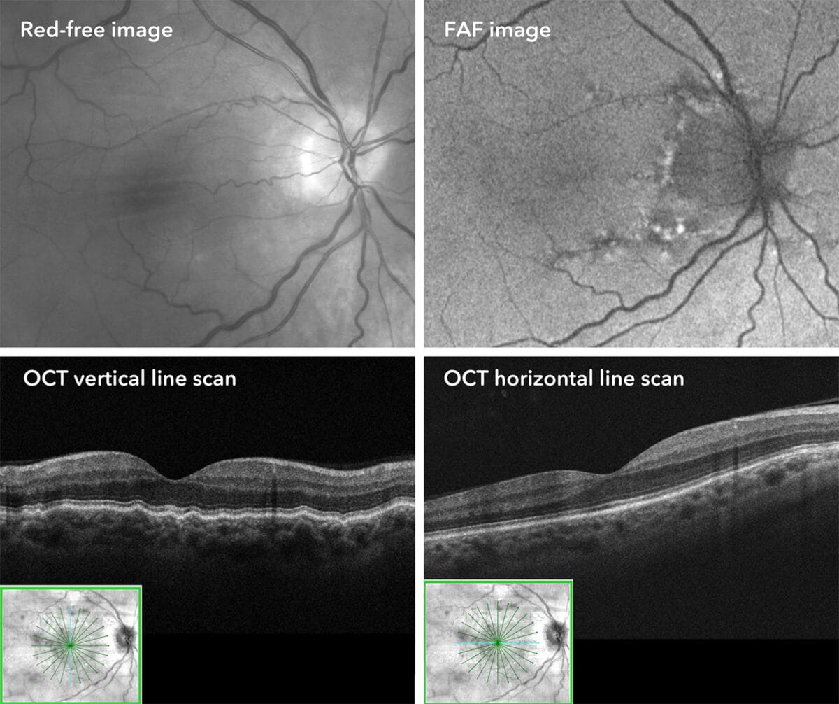 Choroidal Folds Benign Retinal Finding or Something More? - mivision