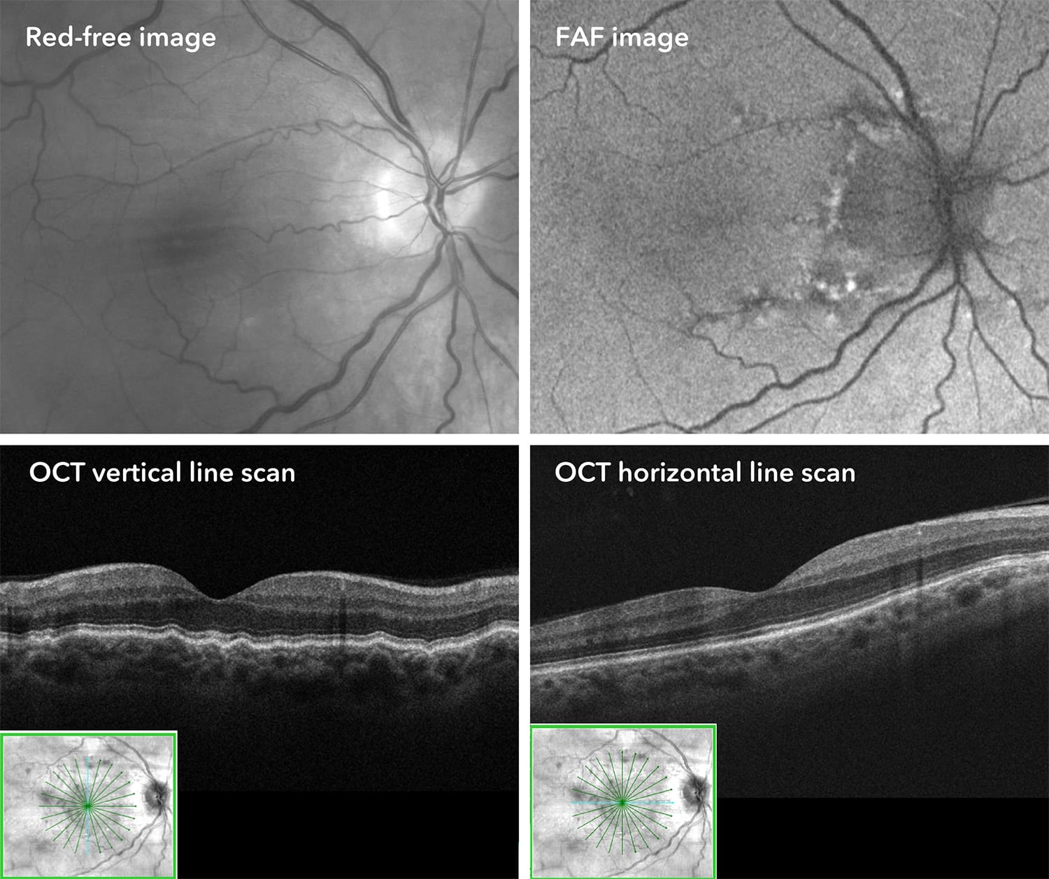 Choroidal Folds Benign Retinal Finding or Something More? - mivision
