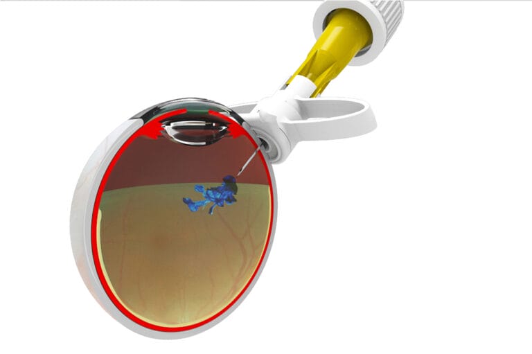 Intravitreal Injections: Building Sustainability into Disease Treatment ...