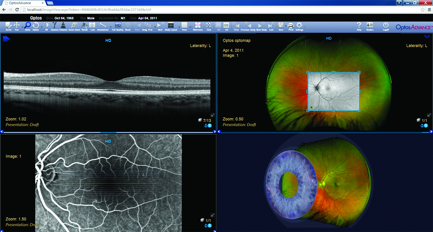 Revolutionising Diabetes Management: Ultra-widefield Retinal Imaging ...