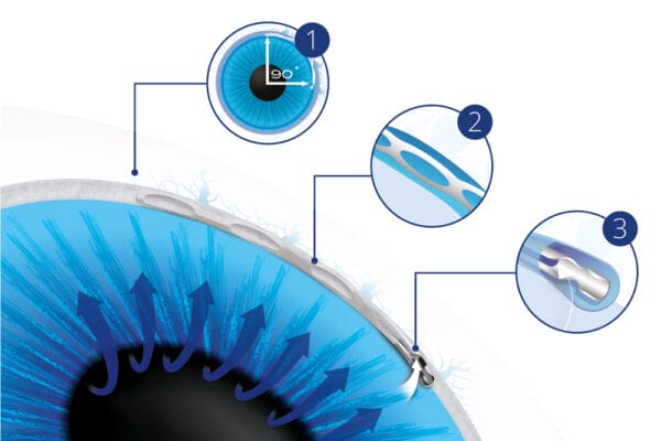 Hydrus Microstent - mivision