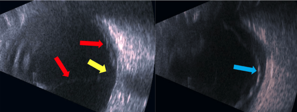 What the Hole?! When to Refer Retinal Holes or Tears - mivision