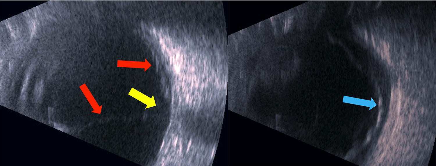 What the Hole?! When to Refer Retinal Holes or Tears - mivision