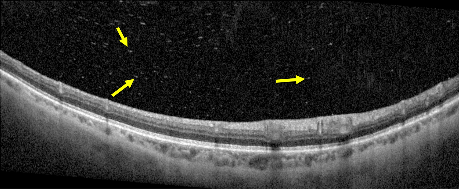 What the Hole?! When to Refer Retinal Holes or Tears - mivision