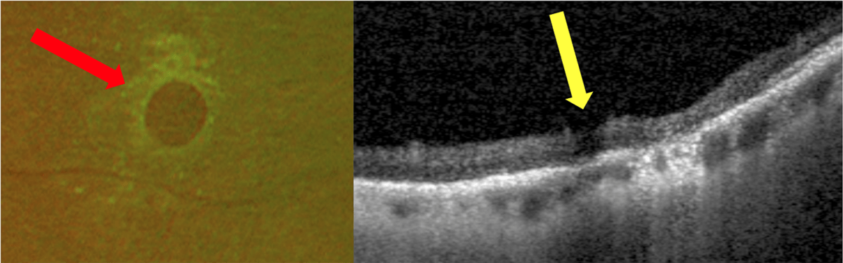 What the Hole?! When to Refer Retinal Holes or Tears - mivision