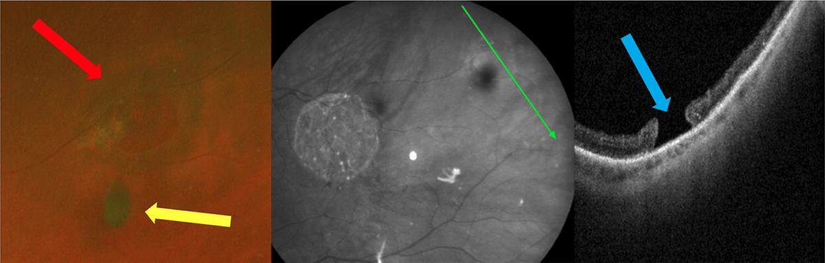 What the Hole?! When to Refer Retinal Holes or Tears - mivision