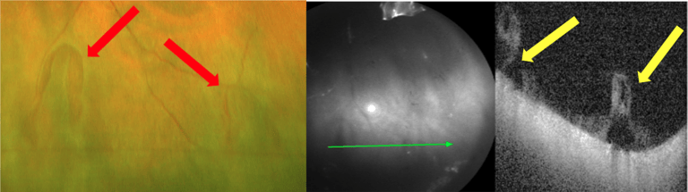 What the Hole?! When to Refer Retinal Holes or Tears - mivision