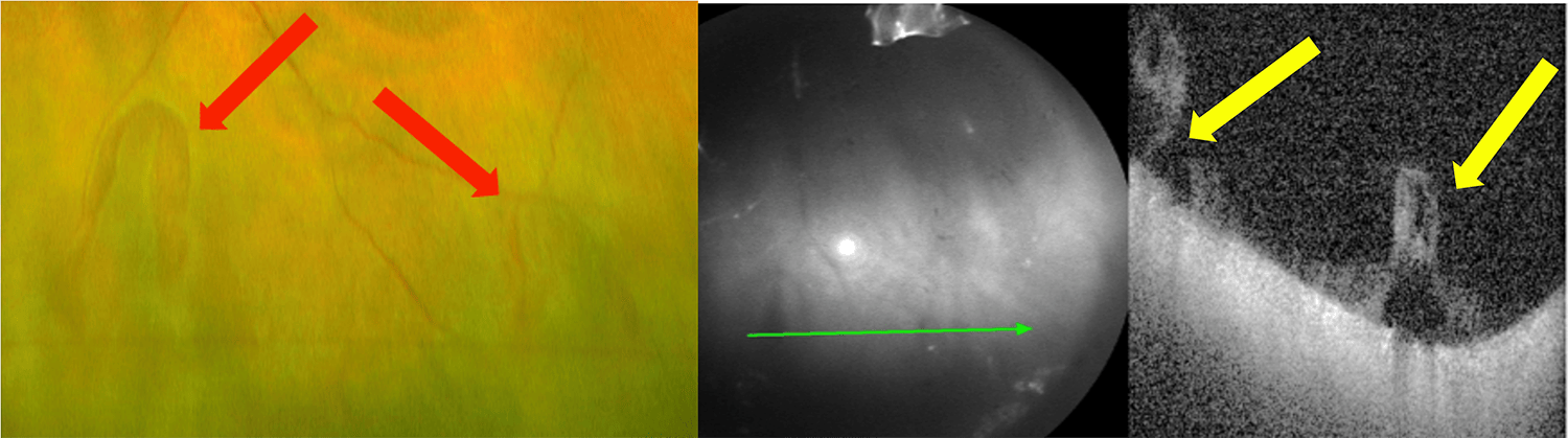 What the Hole?! When to Refer Retinal Holes or Tears - mivision