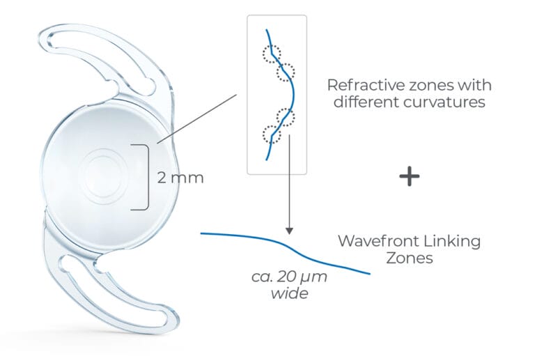 Right on Target: Elon Extended Depth of Focus IOL - mivision
