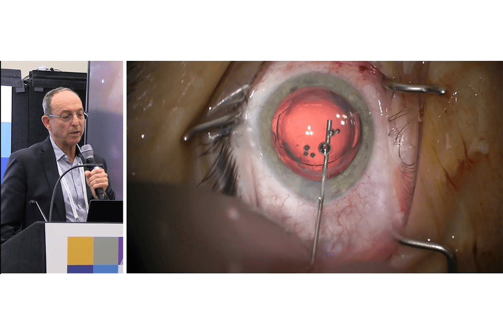 Practical Benefits of 1stQ AddOn IOLs - mivision