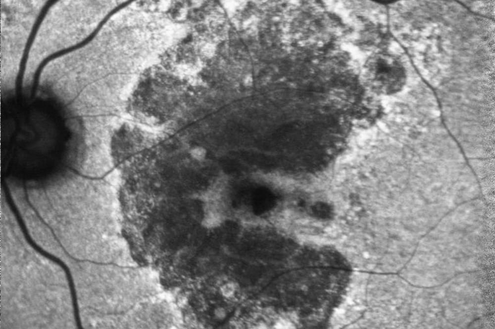 Syfovre Approved for Geographic Atrophy (GA) - mivision