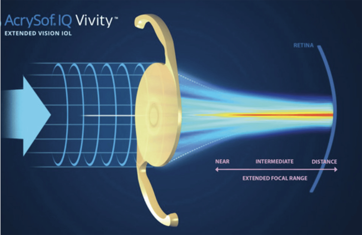 Cataract Surgery and AMD: What You Need to Know - mivision