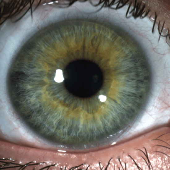 Syfovre Approved for Geographic Atrophy (GA) - mivision