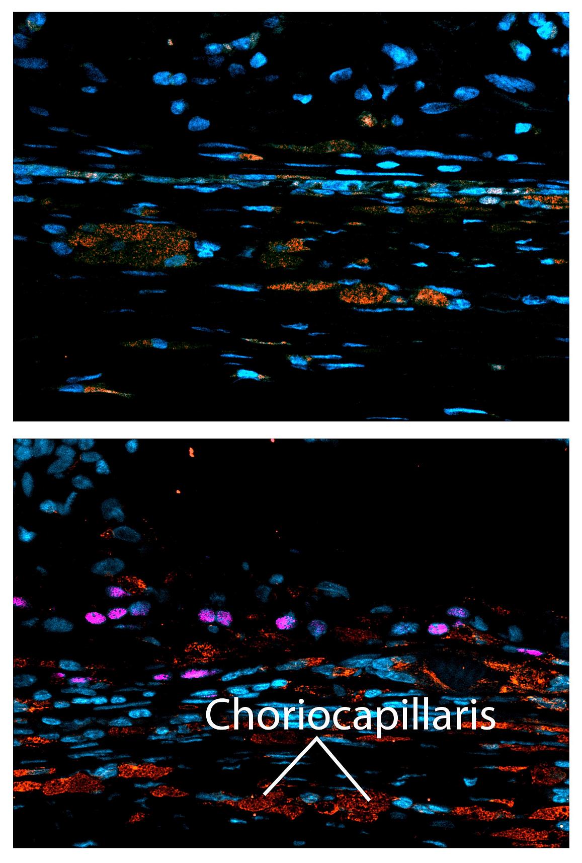 RPE Tissue Grafts for Dry AMD - mivision