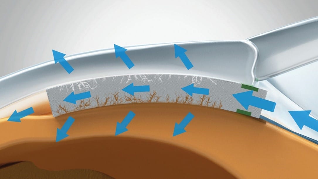 First of the Latest MINIject MIGS Devices Implanted in Australia - mivision