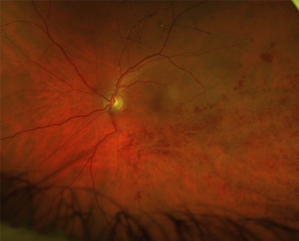 Putting the Spotlight on Retinal Vein Occlusions - mivision