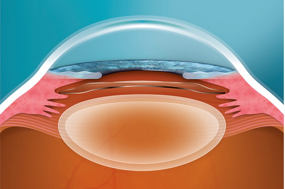 Surgical Vision Correction: From Laser to Lenses - mivision
