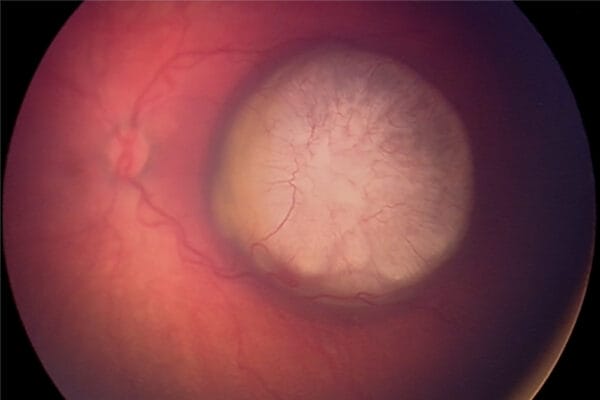 Could the Squint be a Sign? Strabismus and Childhood Malignancy - mivision