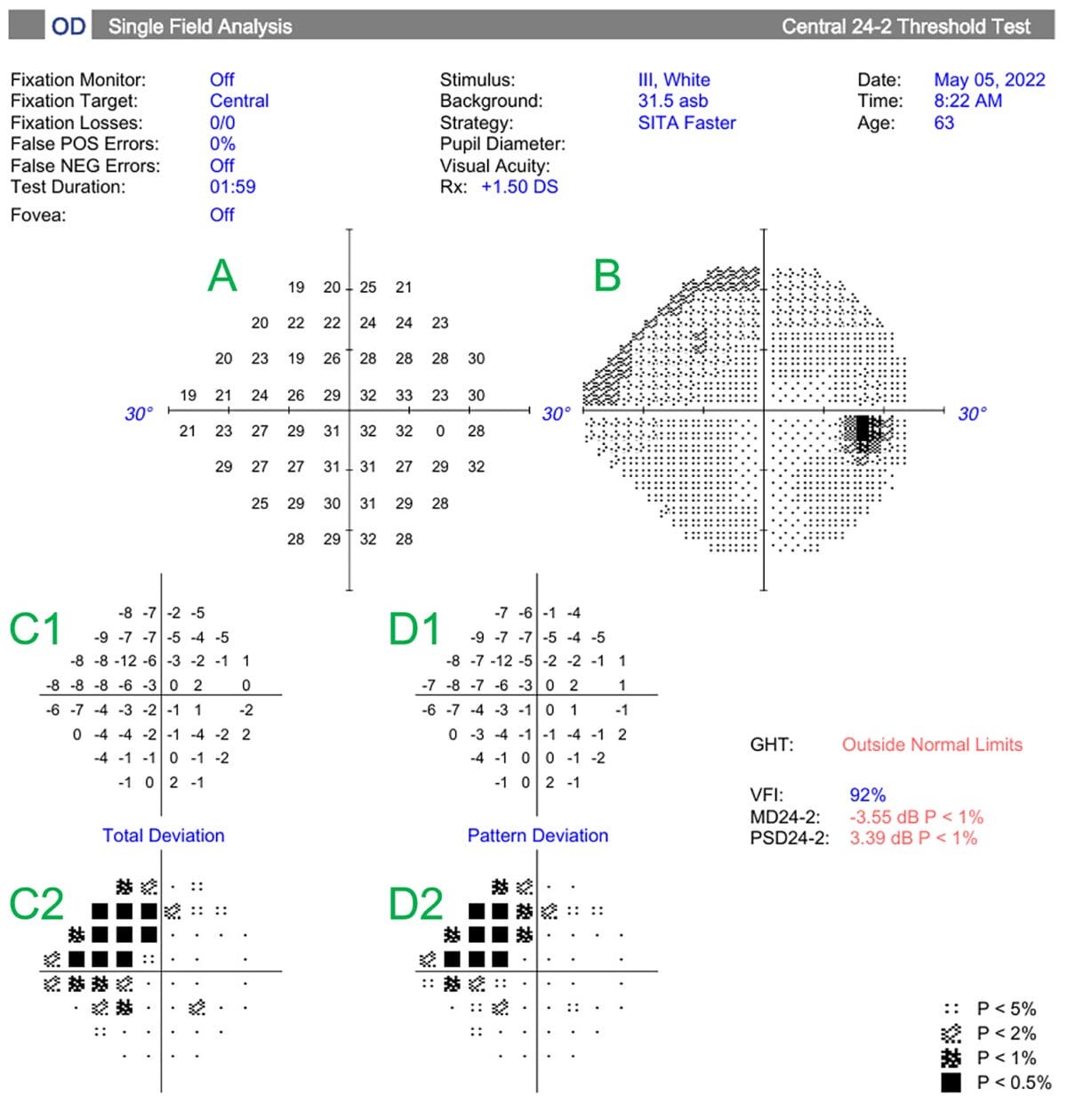 Visual Field Testing: A Guide to Interpreting Reports - mivision