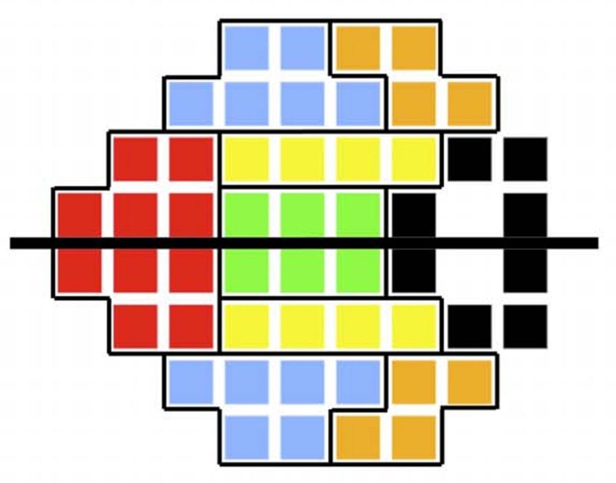 Visual Field Testing: A Guide to Interpreting Reports - mivision