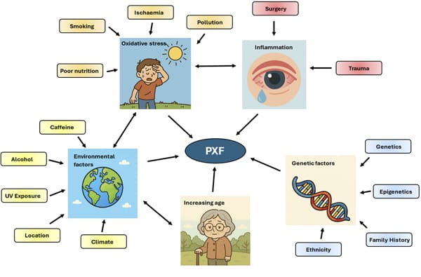 More Than Meets the Eye: Pseudoexfoliation Syndrome - mivision
