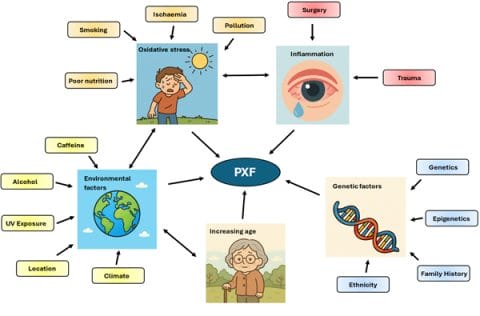 More Than Meets the Eye: Pseudoexfoliation Syndrome - mivision