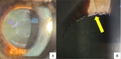 More Than Meets the Eye: Pseudoexfoliation Syndrome - mivision